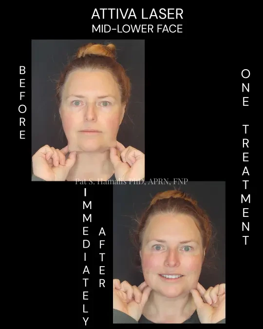 Attiva laser Archives - Luxe Skin Medspa