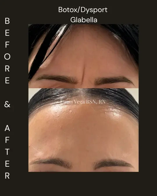 Botox Case 3 - Luxe Skin Medspa